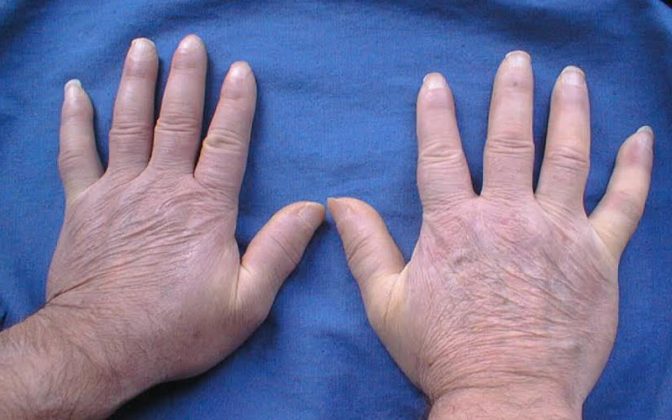 Scleroderma: shedding light on this rare autoimmune disease | Free ...