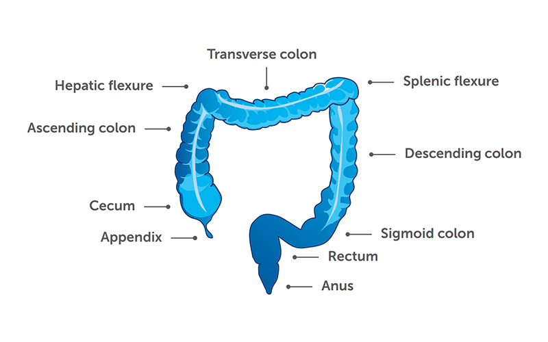 Why colorectal cancer is so common in Malaysia | Free Malaysia Today (FMT)
